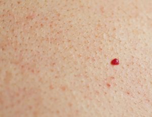 Angioma - Vein Conditions | Triangle Vein Clinic - Cary, NC